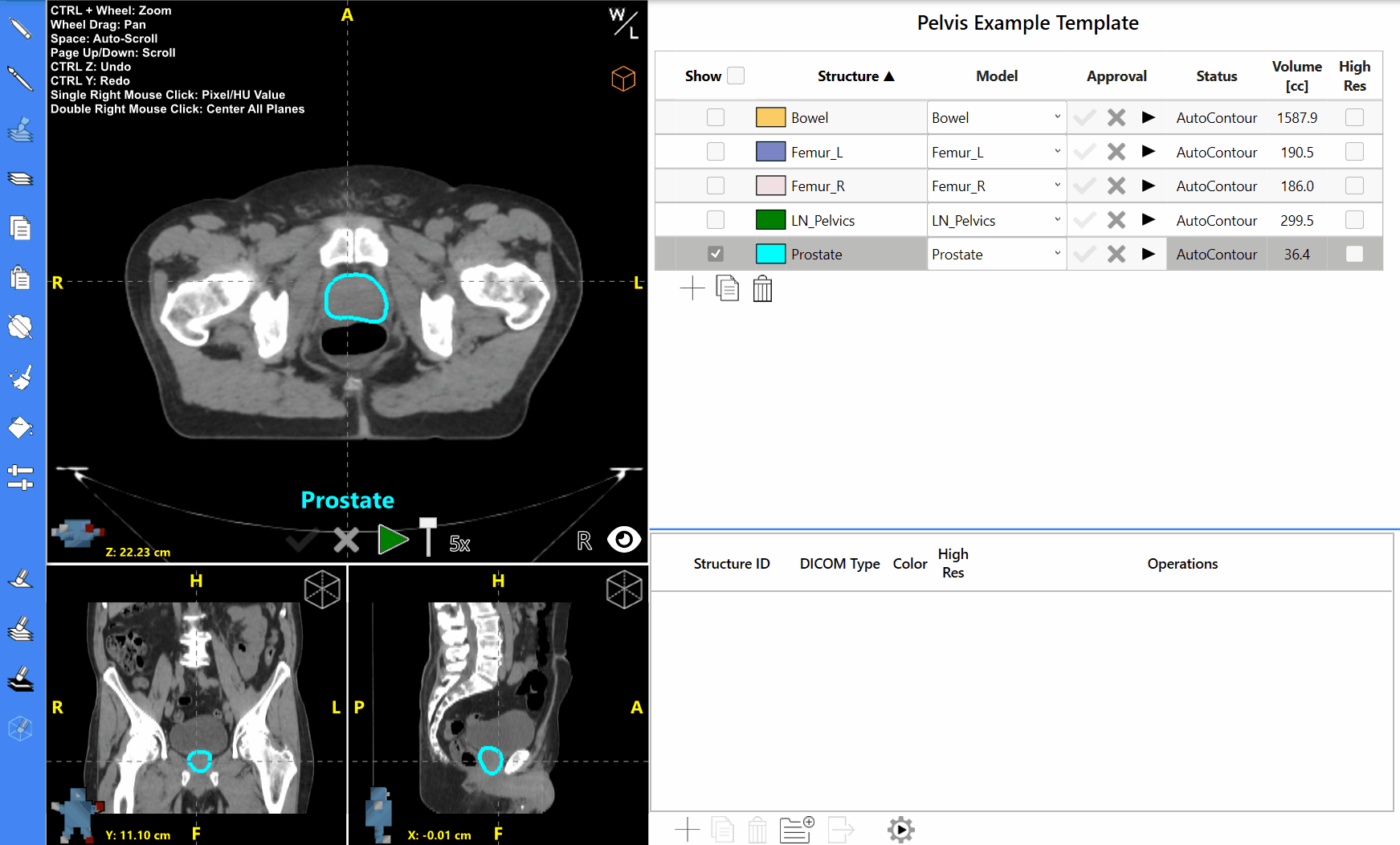 AutoContour Feature Focus: Planning Structure Generation