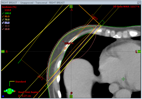 Tips & Tricks: Eclipse Contouring | Radformation