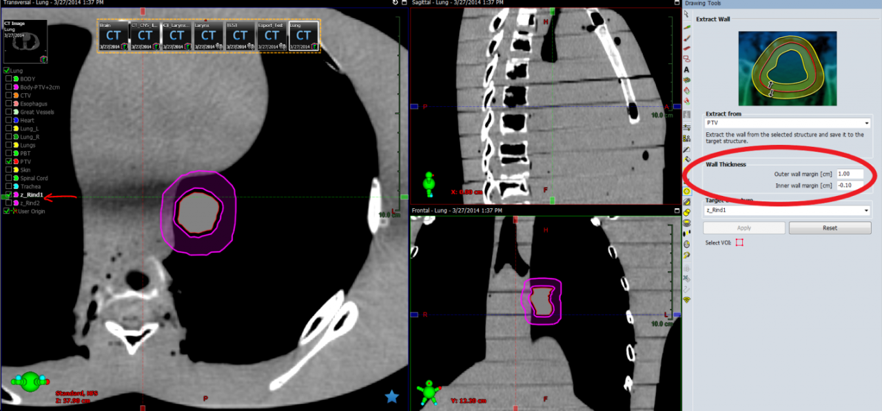 Tips & Tricks: Eclipse Contouring | Radformation