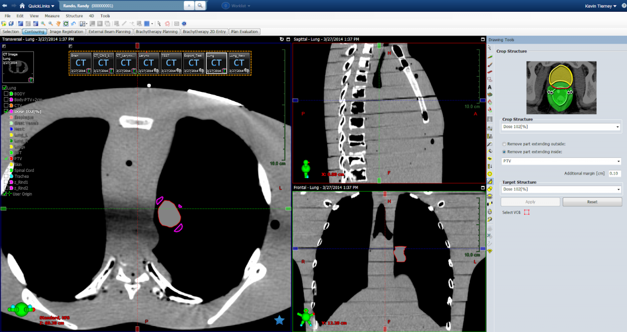 Tips & Tricks: Eclipse Contouring | Radformation
