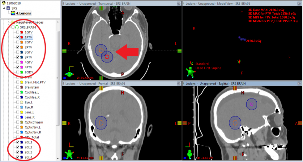 Tips & Tricks: Eclipse Contouring | Radformation