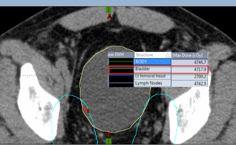Clinical Focus: Mastering BED And EQD2 With ClearCheck | Radformation