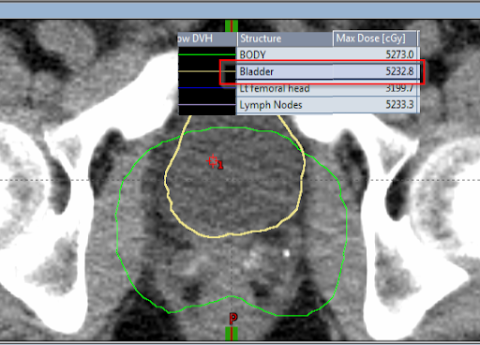 Clinical Focus: Mastering BED And EQD2 With ClearCheck | Radformation