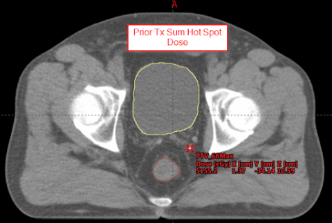 Clinical Focus: Mastering BED And EQD2 With ClearCheck | Radformation
