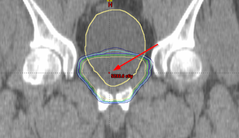 Clinical Focus: Mastering BED And EQD2 With ClearCheck | Radformation