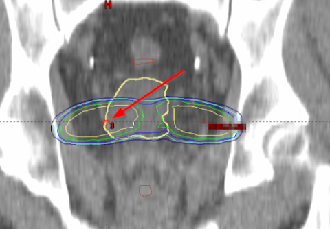 Clinical Focus: Mastering BED And EQD2 With ClearCheck | Radformation